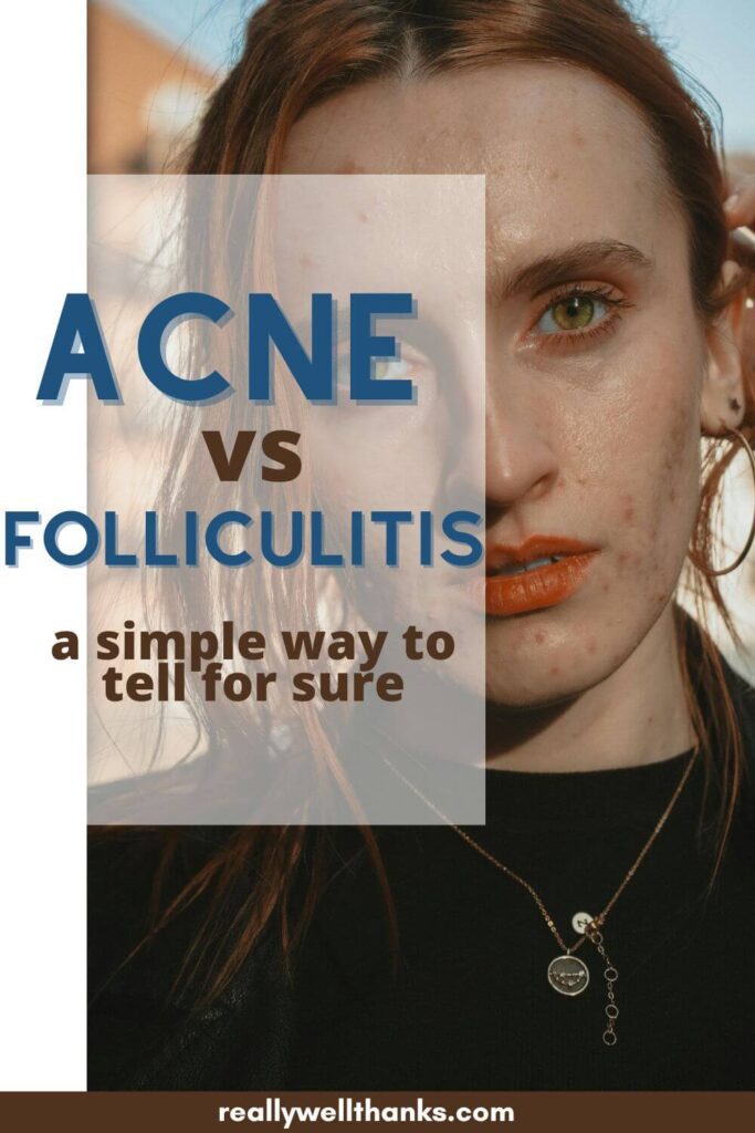 Folliculitis vs Acne: How to Know and What Next - really well, thanks!